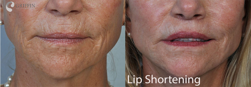 Before & Afters Columbus MS, Griffin Center for Cosmetic Surgery