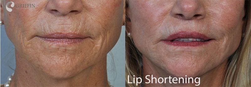 Facial Cosmetic Surgery Before & After Gallery | Cosmetic Surgery